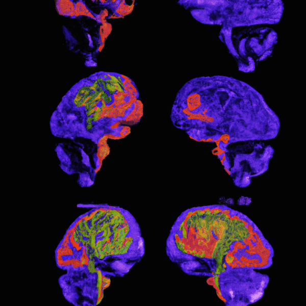 Understanding Brain Imaging Studies in ADHD Research